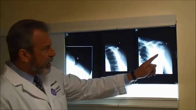 Equinoxe Reverse System | Total Shoulder Arthroplasty | Exactech